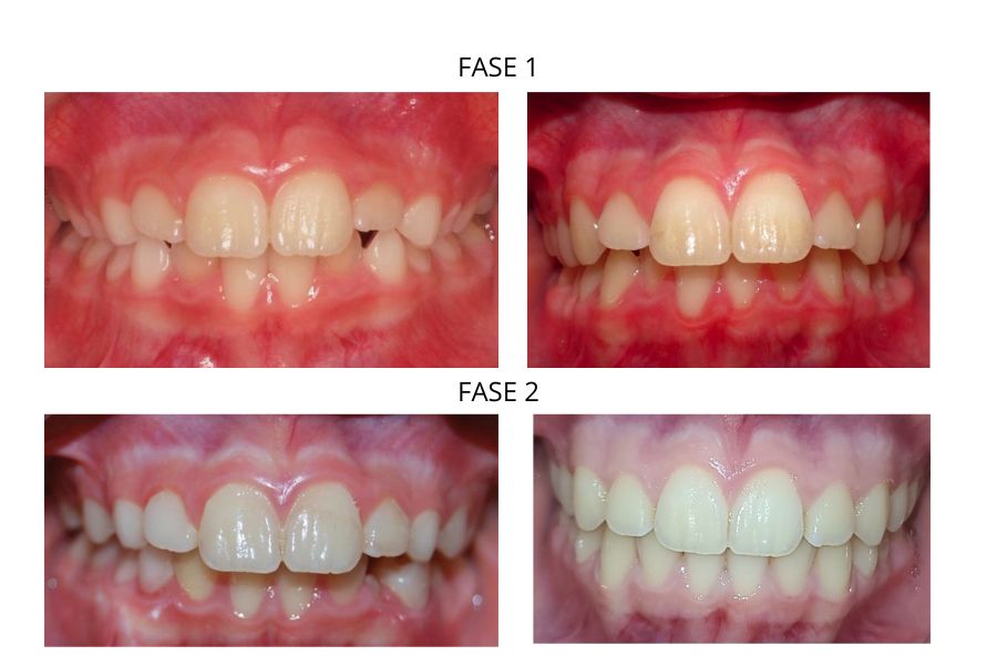 ¿En qué consiste la Ortodoncia en dos fases?