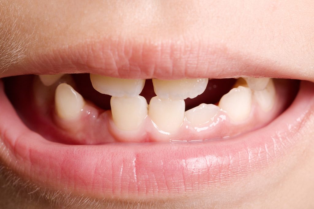 Agenesia Dental: Qué Es Y Por Qué Se Produce – UOOO